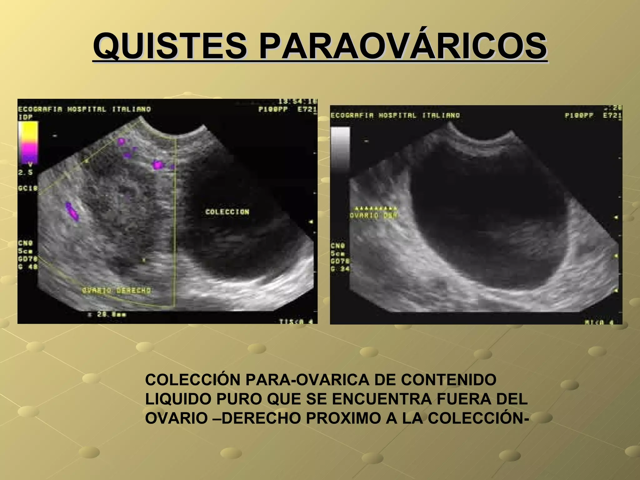 Tumores benignos ovario