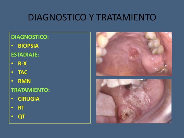 Tumores benignos y malignos de cavidad oral