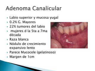 Neoplasias de las Glandulas Salivares Ivan Minaya | PPTX