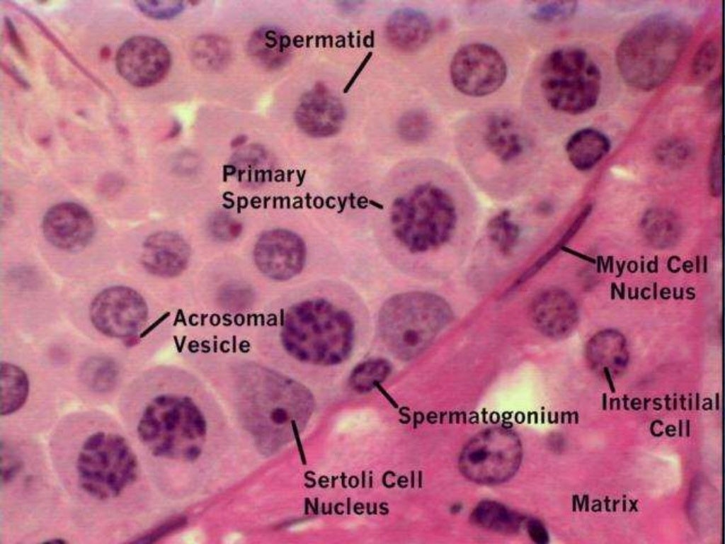 Tumores de células de sertoli
