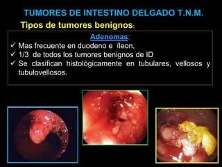 Tumores de intestino delgado tnm. ekipo 6 2 | PPTX