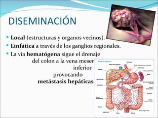 Cáncer de colon | PPT