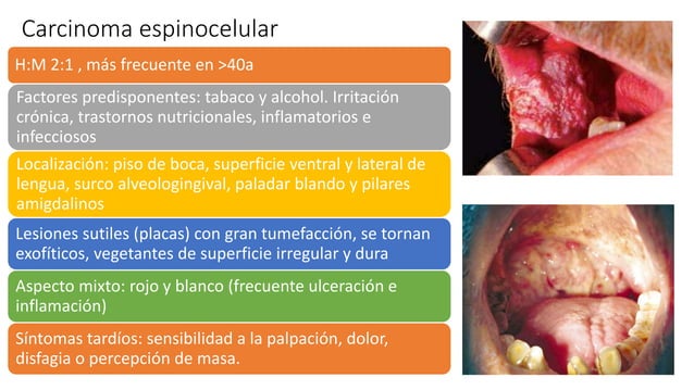 Tumores de la cavidad oral y orofaringe