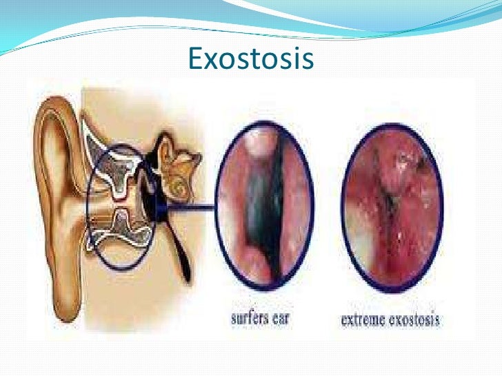 Tumores De Oido Externo