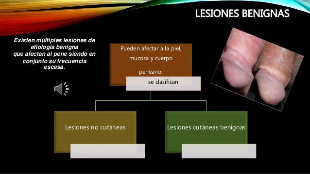 Qué Causa La Lesión En El Pene Elzyl