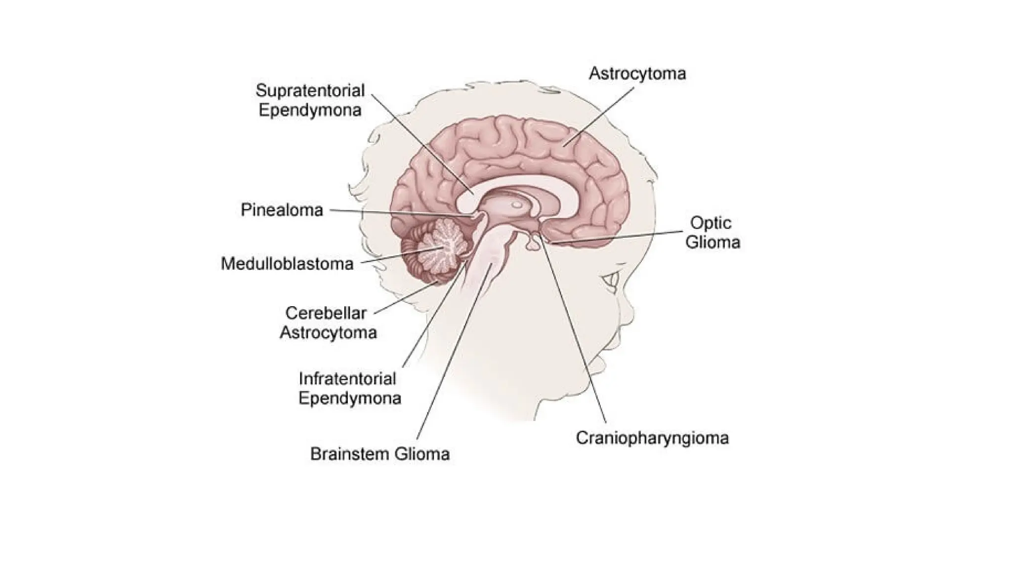 Tumores fosa posterior anestesia neurocirugia | PPTX