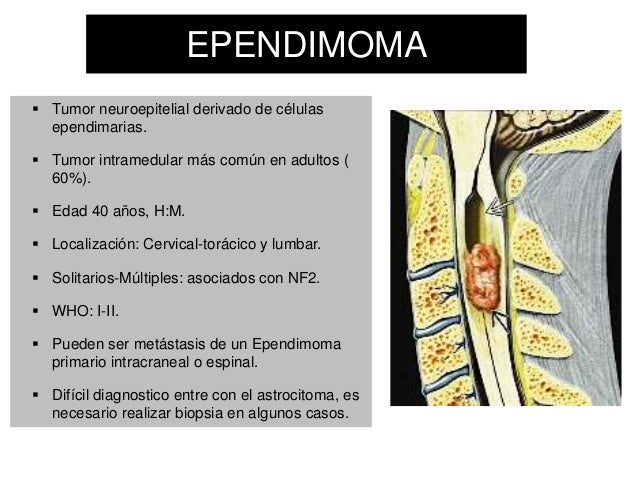 Tumores intramedulares cervicales hallazgos por Resonancia Magnetica