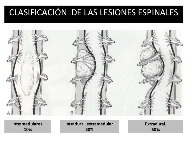 Tumores intramedulares cervicales hallazgos por Resonancia Magnetica