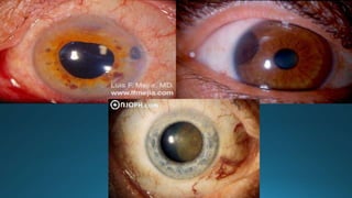 TUMORES INTRAOCULARES | PPTX