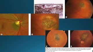 TUMORES INTRAOCULARES | PPTX