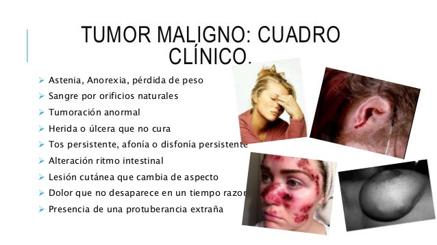Tumores malignos