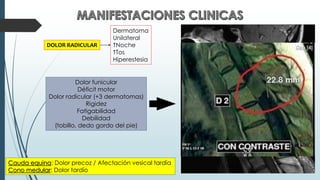 Tumores Medula Espinal | PPTX