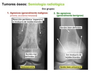 Tumores oseos benignos, traumatología y ortopedia | PDF | Bone and Joint Conditions | Diseases ...
