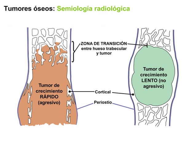Tumores oseos benignos, traumatología y ortopedia | PDF | Bone and Joint Conditions | Diseases ...