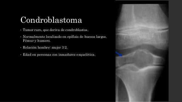 Tumores oseos benignos fomadores de cartilago