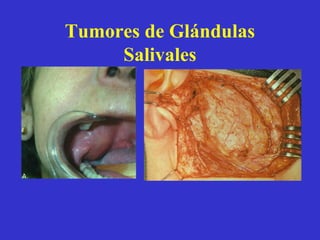 Tumores salivales | PPT
