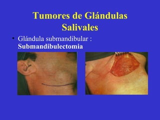 Tumores salivales | PPT
