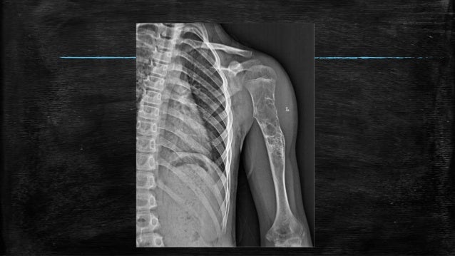 descripcion radiologica de tumores oseos, radiologia en tumores oseo…