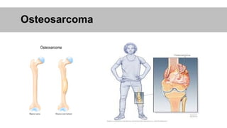 Tumores óseos mas comunes en Pediatría.pptx