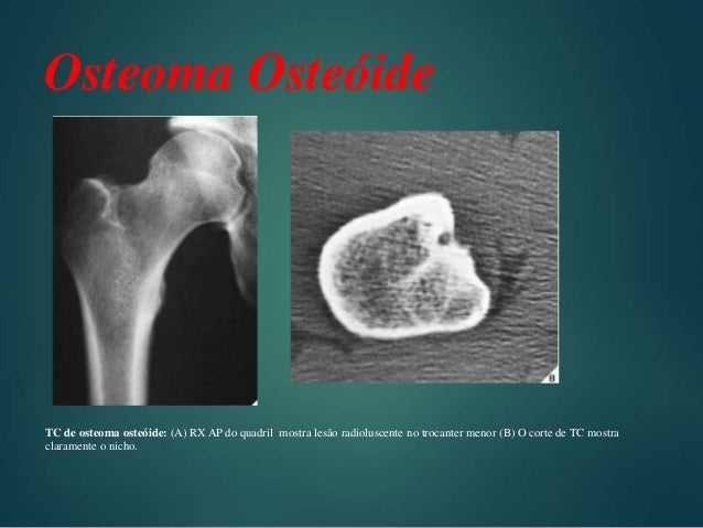 Tumores ósseos benignos