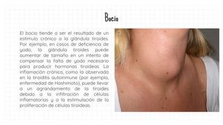 Tumores Tiroideos; Clínica de Endocrinología | PPTX