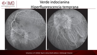 Tumores vasculares de la retina y coroides - Vascular tumors of the ...