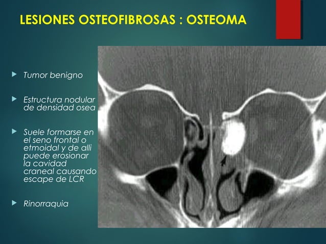 TUMORES Y PATOLOGIAS DE SENOS PARANASALES | PPT