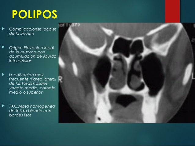 TUMORES Y PATOLOGIAS DE SENOS PARANASALES