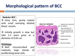 Malignant Tumor of eyelid | PPTX