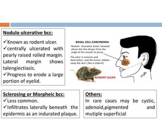 Malignant Tumor of eyelid | PPTX