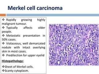 Malignant Tumor of eyelid | PPTX
