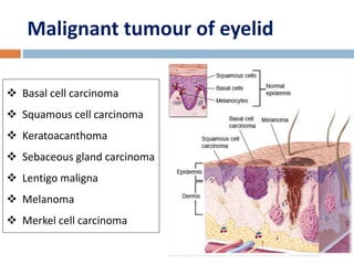 Malignant Tumor of eyelid | PPTX