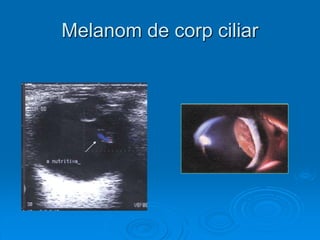 ULTRASOUND IN OCULO-ORBITAL TUMOURS | PPT