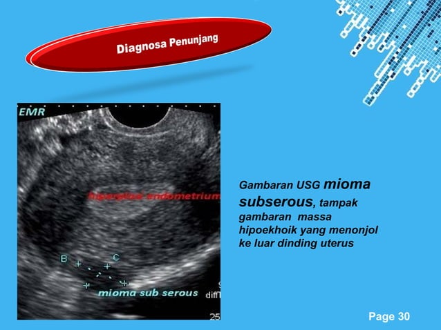 Tumor jinak & mioma uteri | PPT