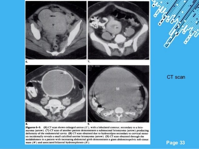 Tumor Jinak And Mioma Uteri