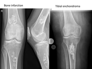 Tumor like lesions of bone | PPTX