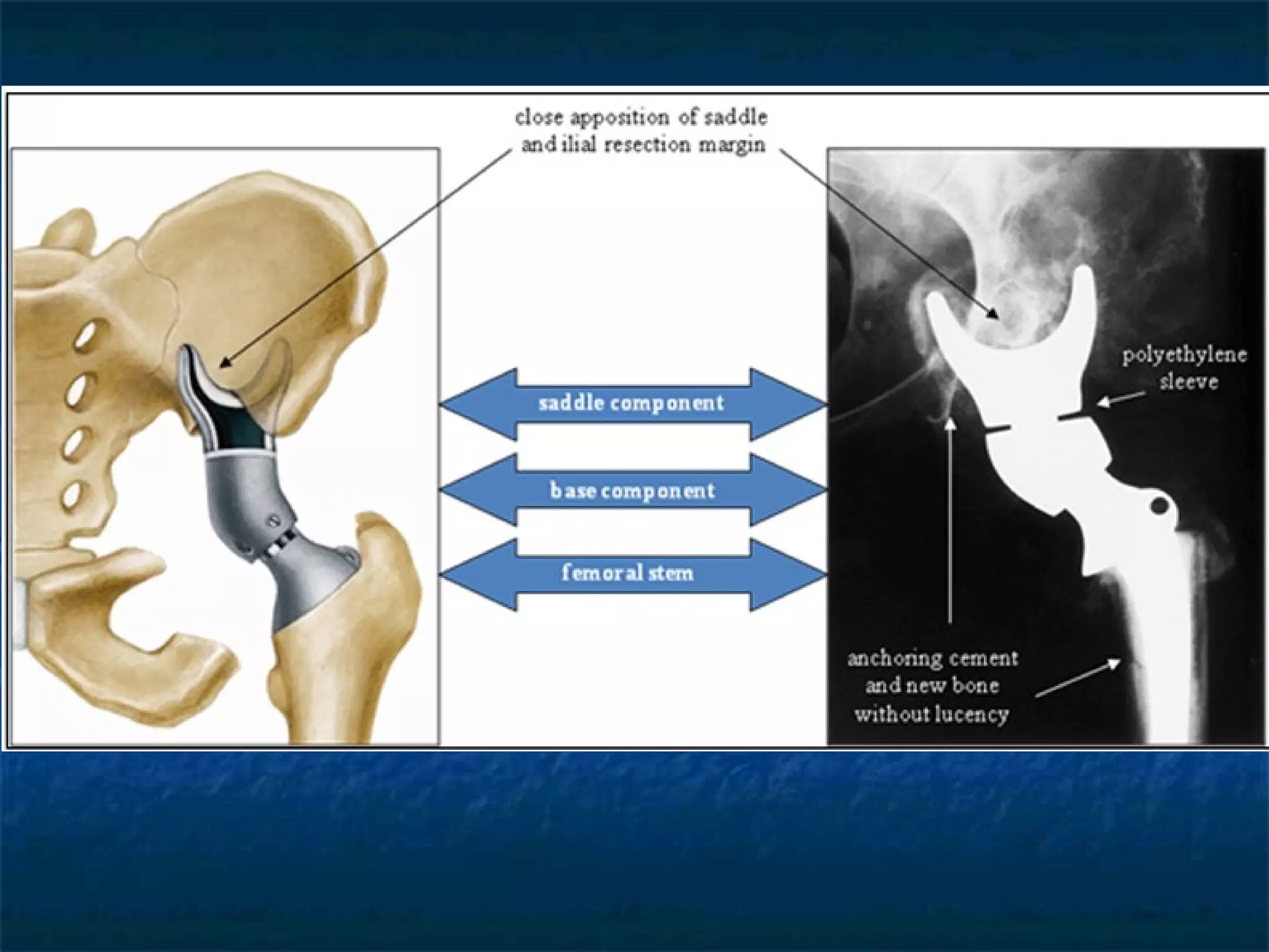 Tumor mega prosthesis | PPT