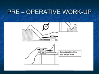 Tumor mega prosthesis | PPT