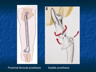 Tumor mega prosthesis | PPT