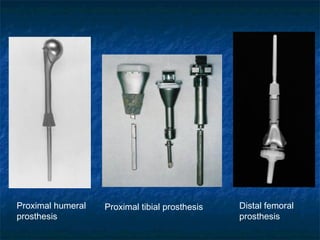 Tumor mega prosthesis | PPT