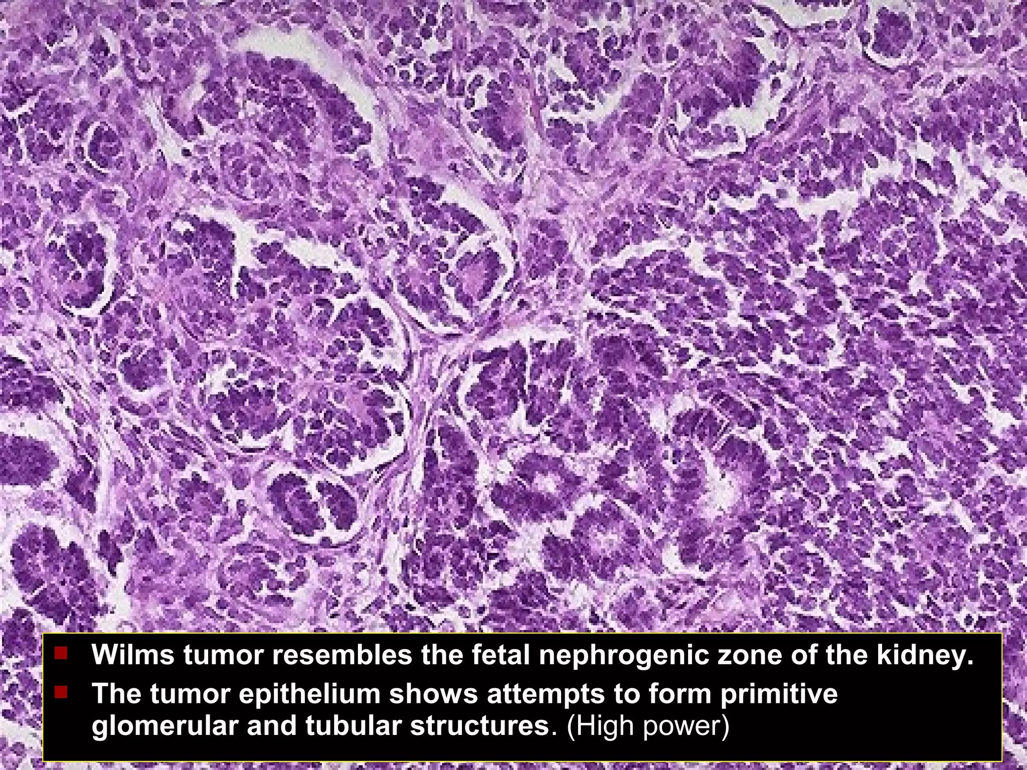 Tumor of kidney and urinary tract | PPT