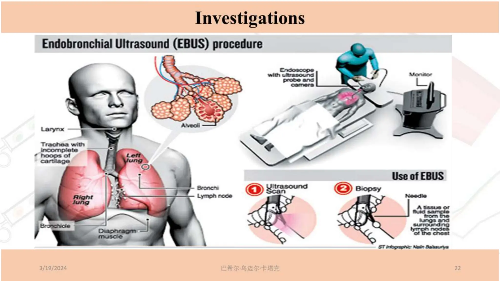 Tumor of lung and mediastinum By Baasir Umair khatak.pptx