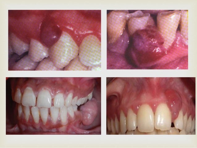 Tumor of oral cavity