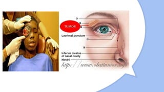 Tumor Orbita | PPTX