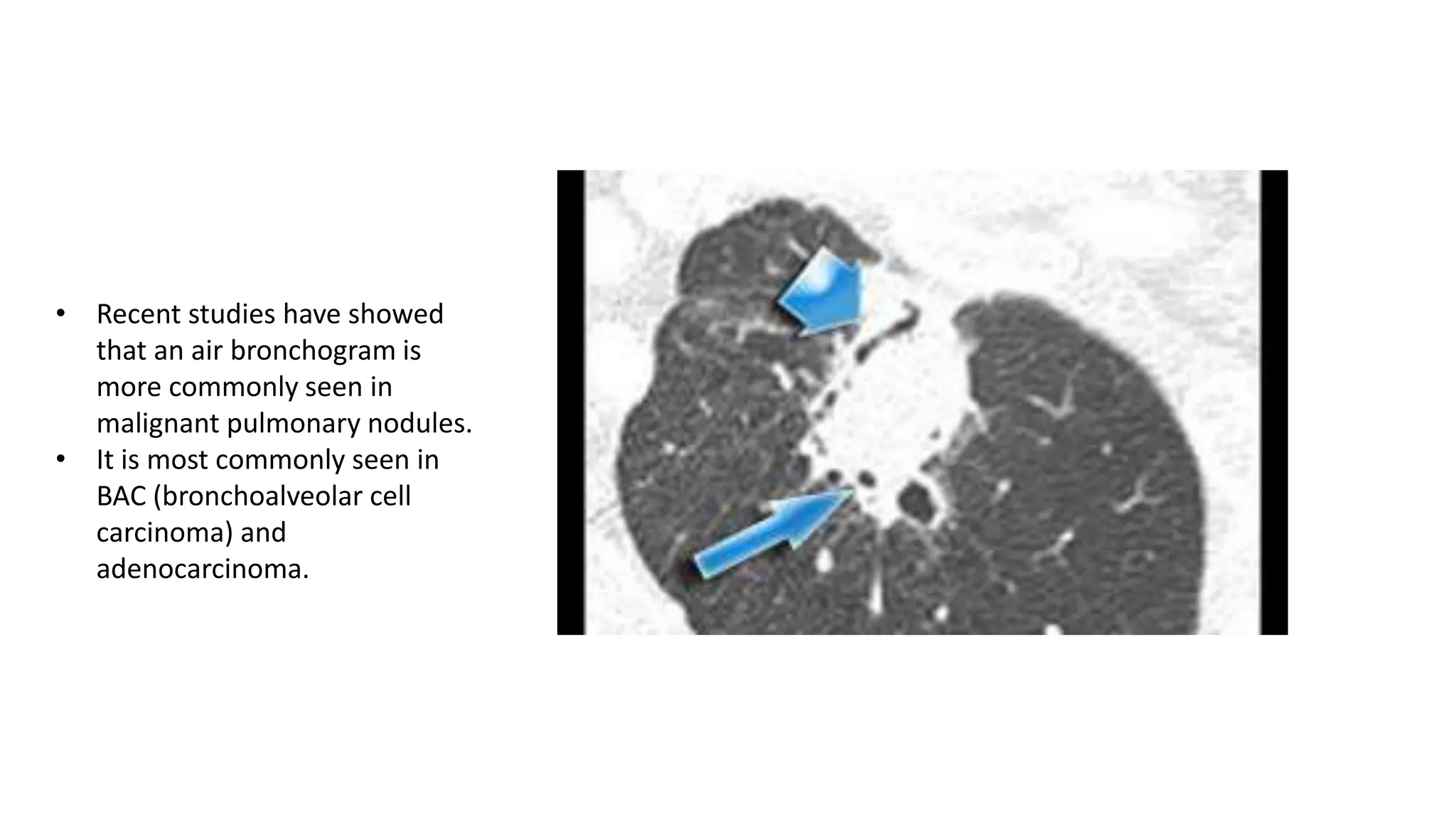TUMOR PARU - lung tumor neoplasm Copy.pptx