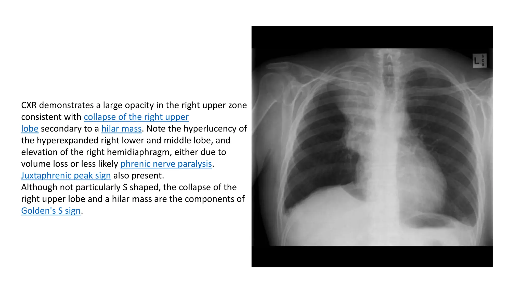 TUMOR PARU - lung tumor neoplasm Copy.pptx