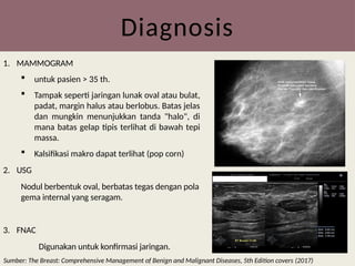 Tumor Payudara,Manifestasi dari fibroadenomamammae, fibrocyst.pptx