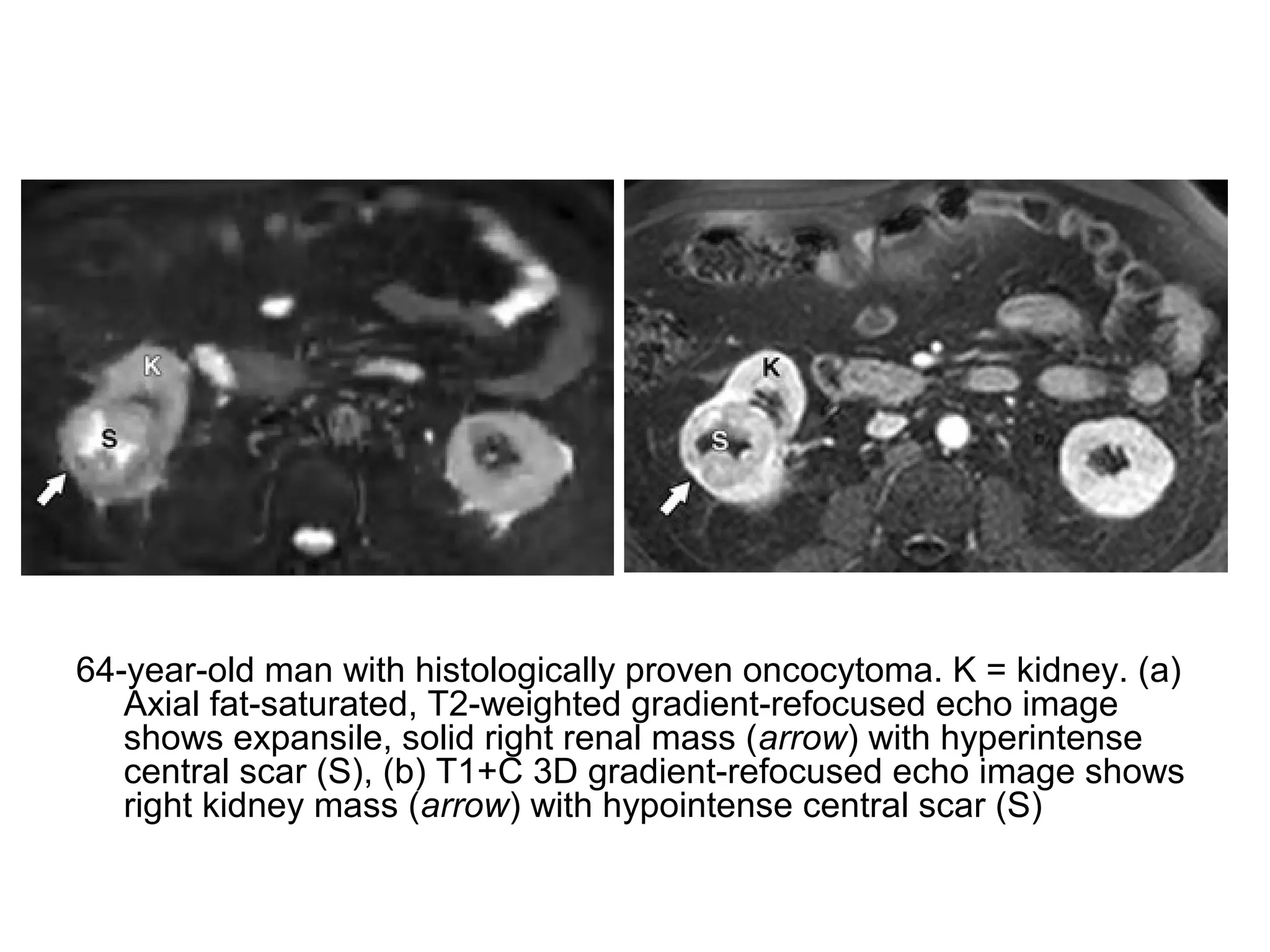 Diagnostic Imaging of Renal Tumors | PPT