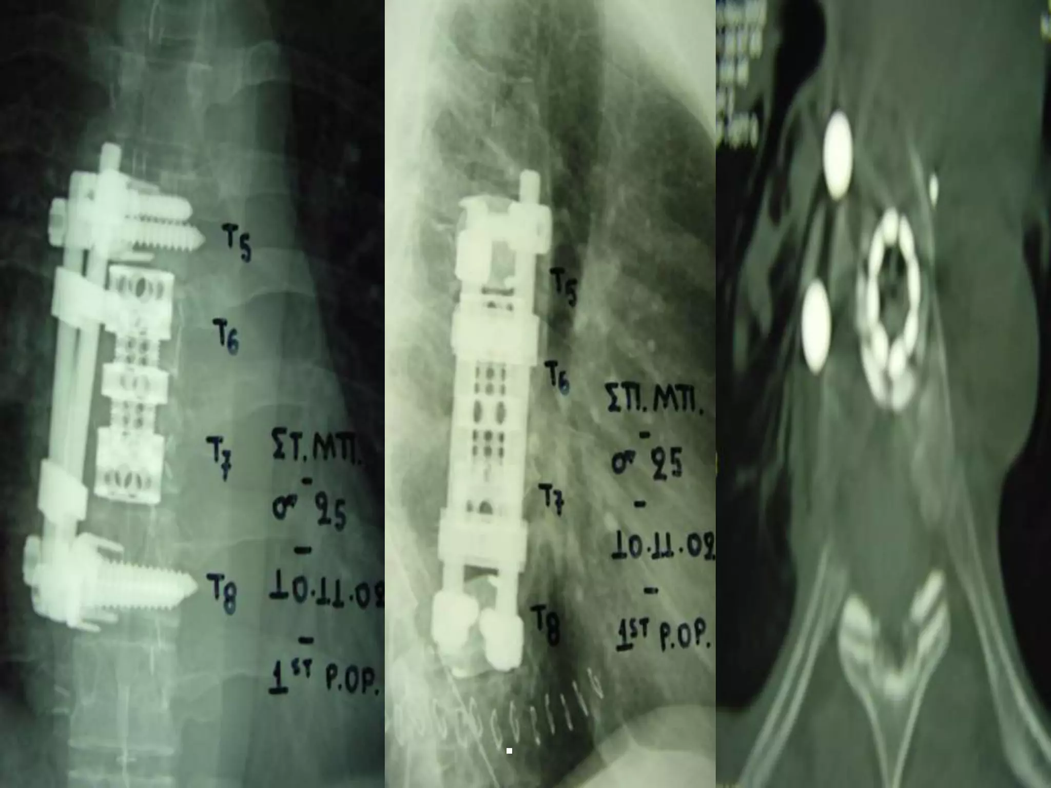 Metastatic Tumors of the Spinal Column: Diagnosis and Treatment | PPT