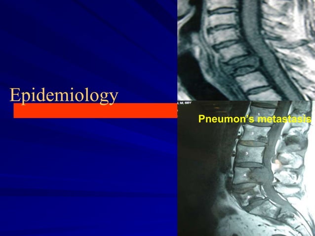 Metastatic Tumors of the Spinal Column: Diagnosis and Treatment | PPT
